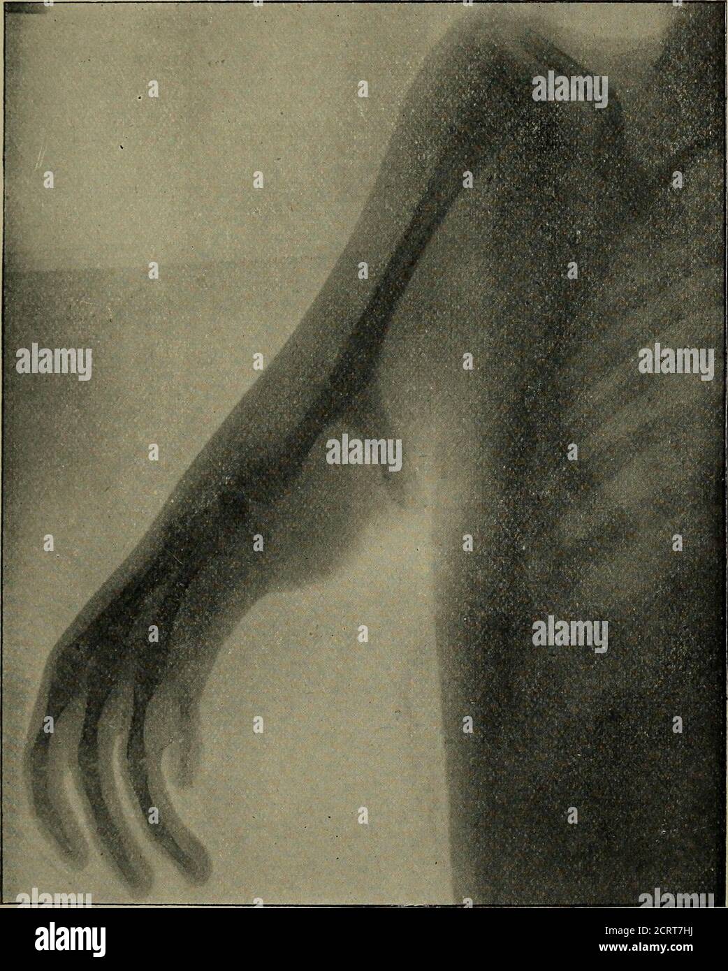 Bifid thumb hi-res stock photography and images - Alamy