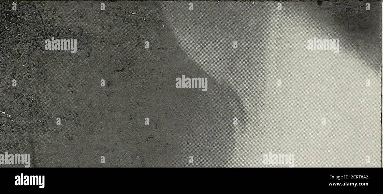 . American quarterly of roentgenology . Fig. 2 ATROPHIC ARTHRITIS ...