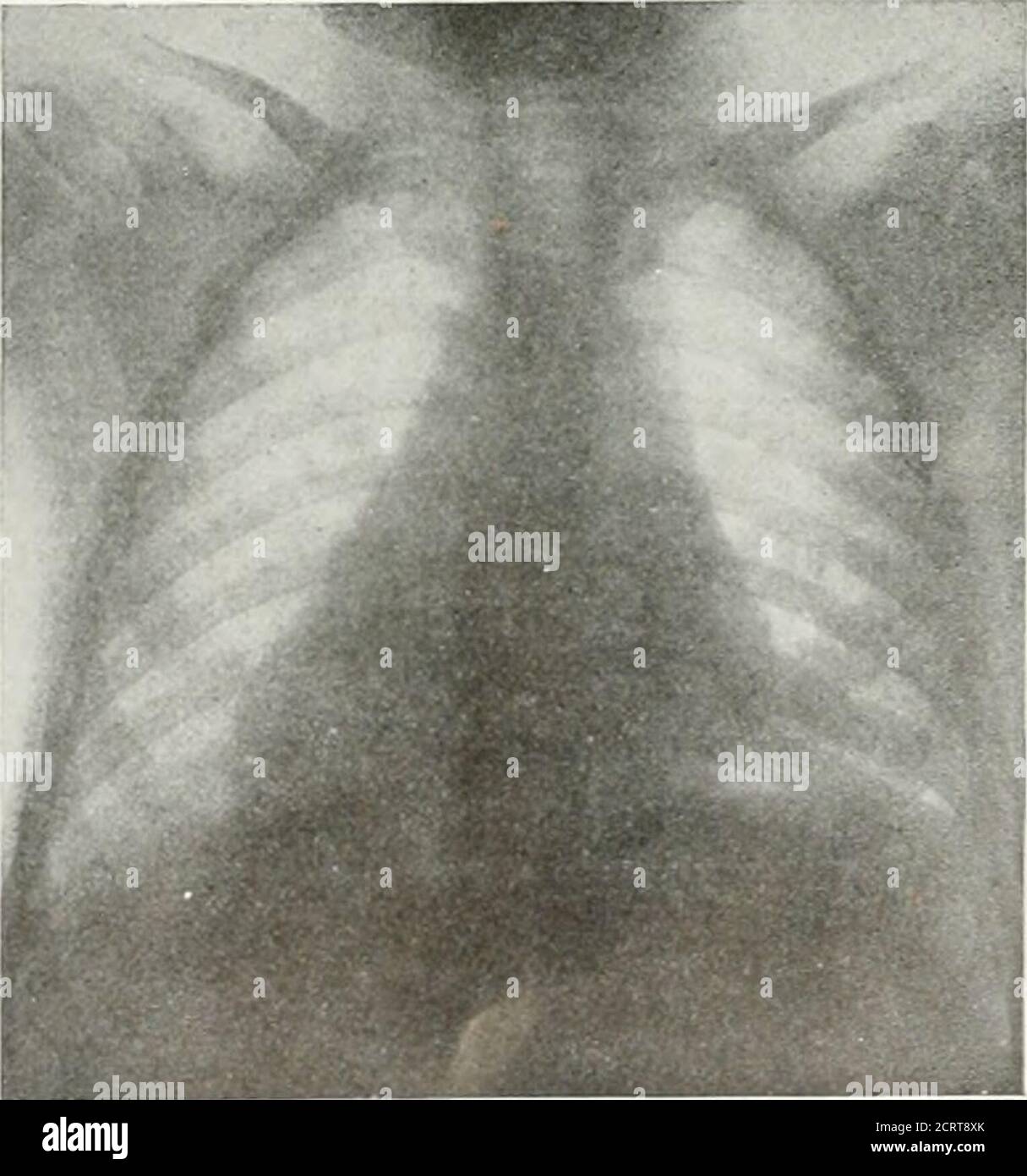 Lung abscess hi-res stock photography and images - Alamy