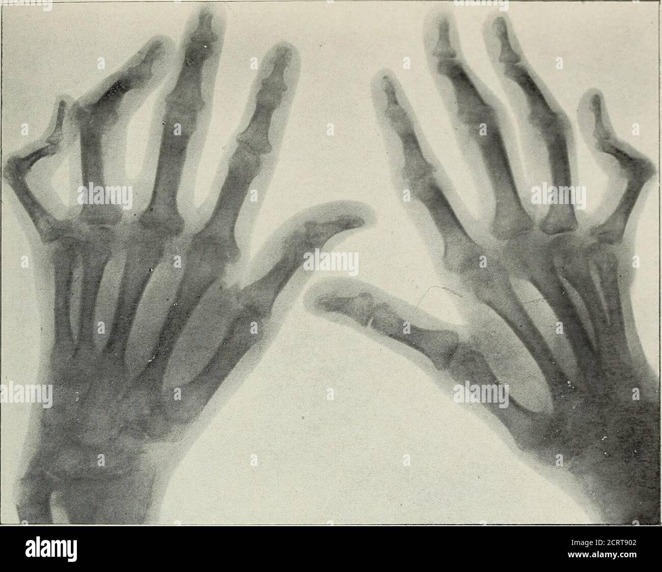 . American quarterly of roentgenology . acebetween the bones will ...
