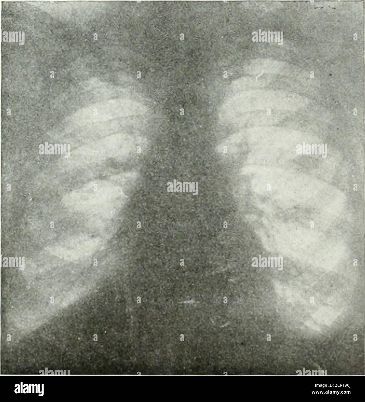 Lung abscesses hi-res stock photography and images - Alamy