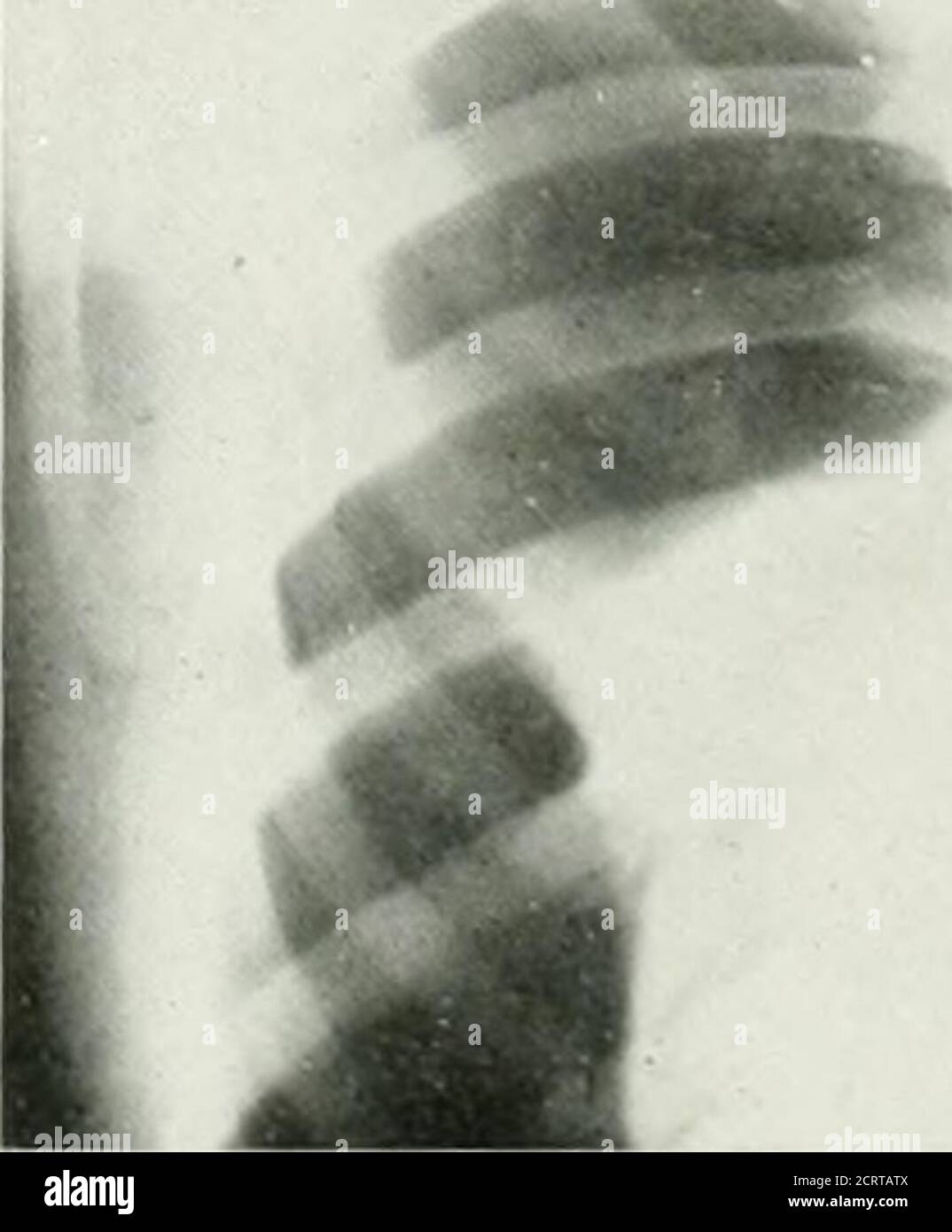 Pyopneumothorax hi-res stock photography and images - Alamy