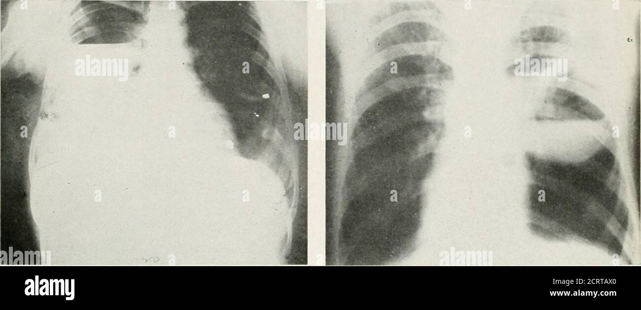 Areolar abscess hi-res stock photography and images - Alamy