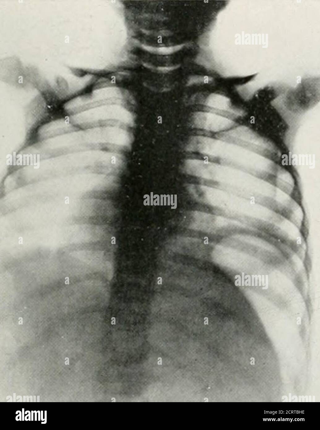 Pyopneumothorax hi-res stock photography and images - Alamy