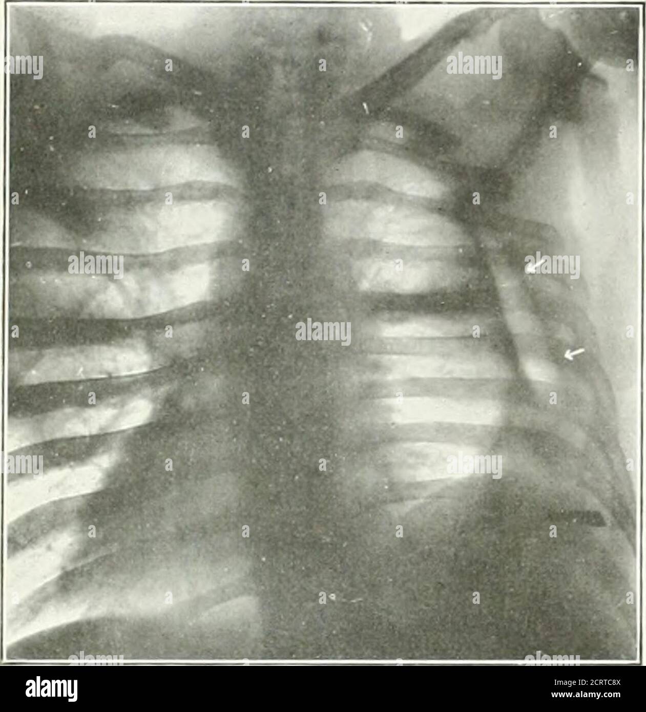 Pleural thickening hi-res stock photography and images - Alamy