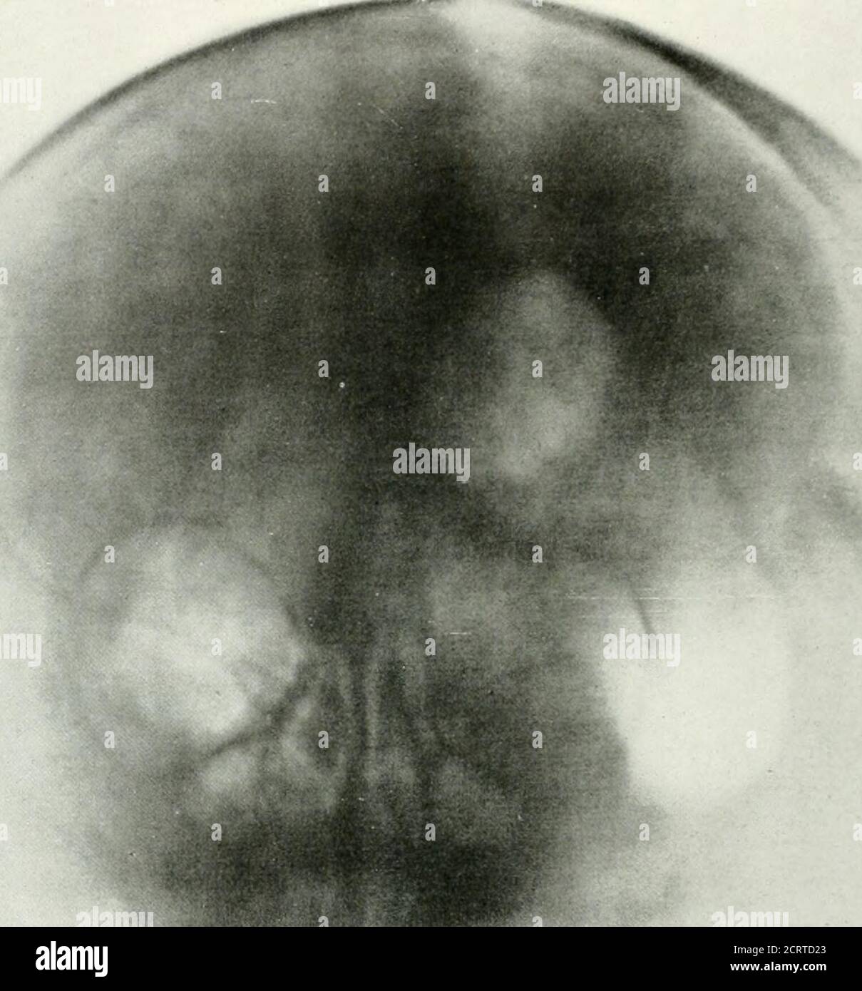 . The American journal of roentgenology, radium therapy and nuclear ...