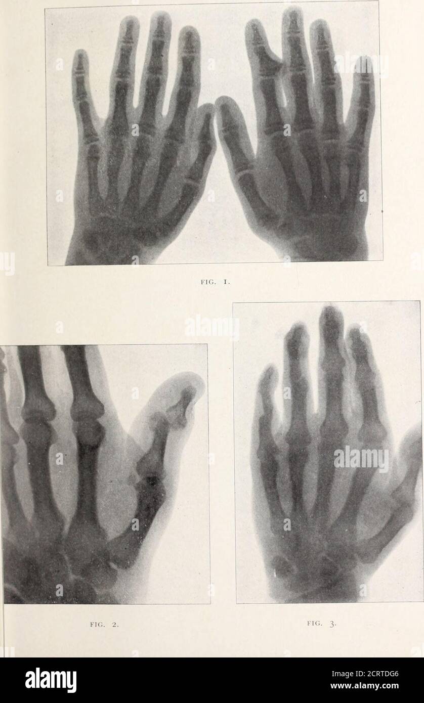 . American X-ray journal . ve callus-formation impaired the function of ...