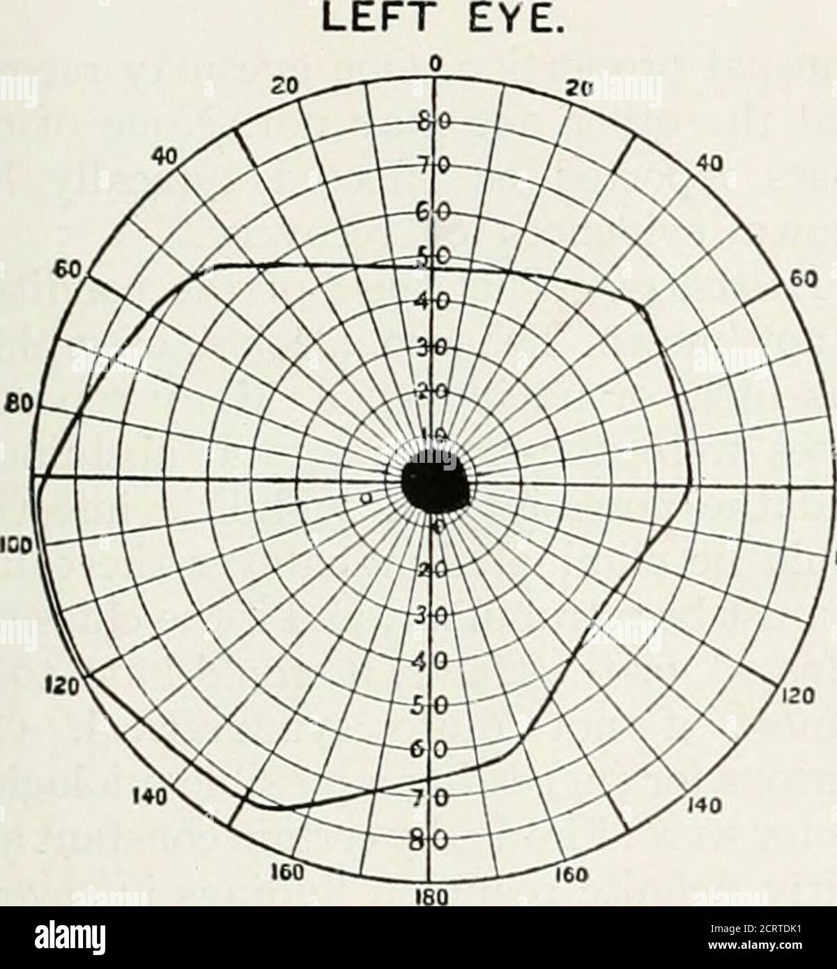 Optic atrophy hi-res stock photography and images - Alamy