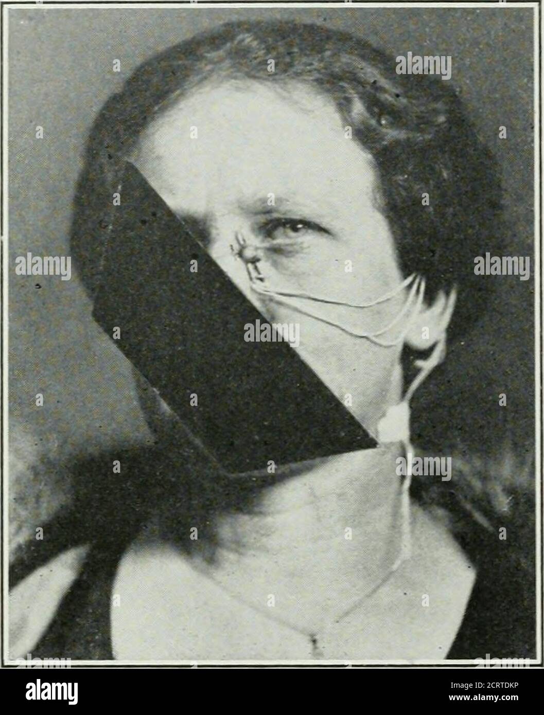 . Radium . pre-ceding radium treatment. Electro-coagulation or even ...