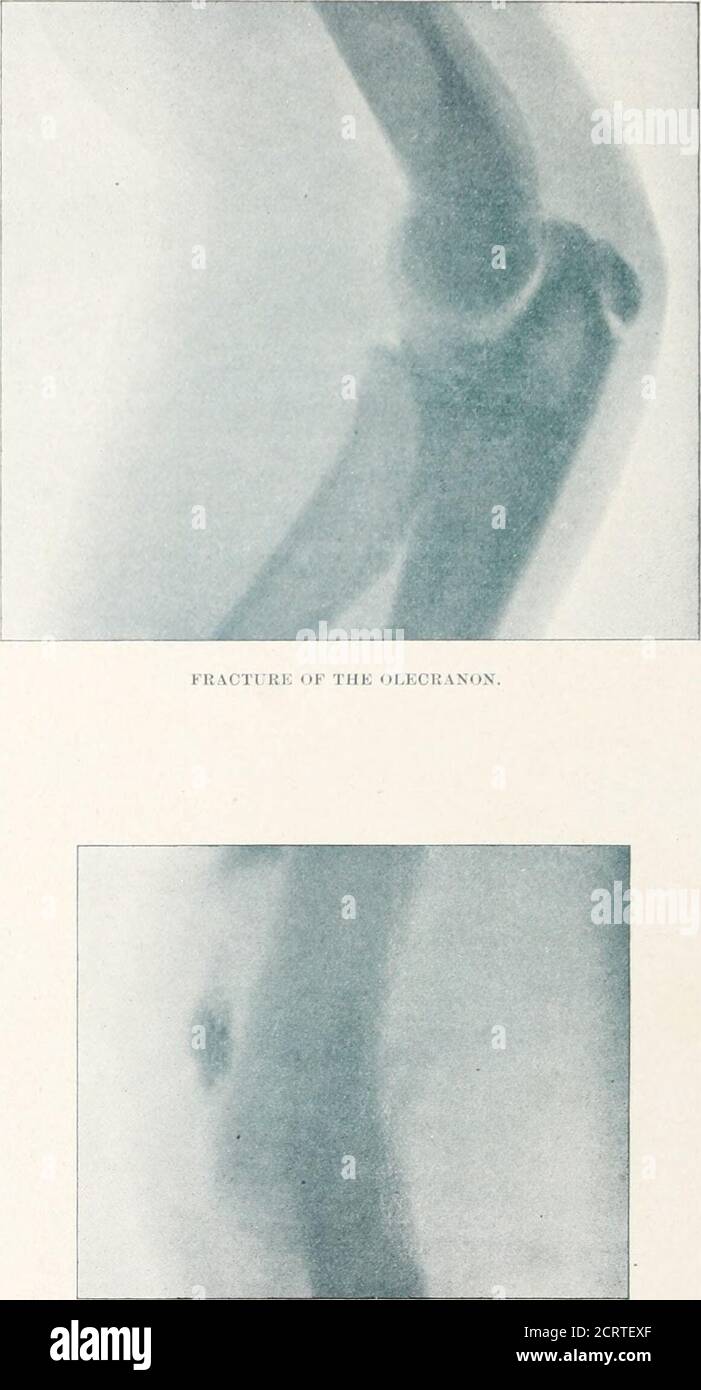 . American X-ray journal . COLLES FRACTURE. 24 days after the accident ...
