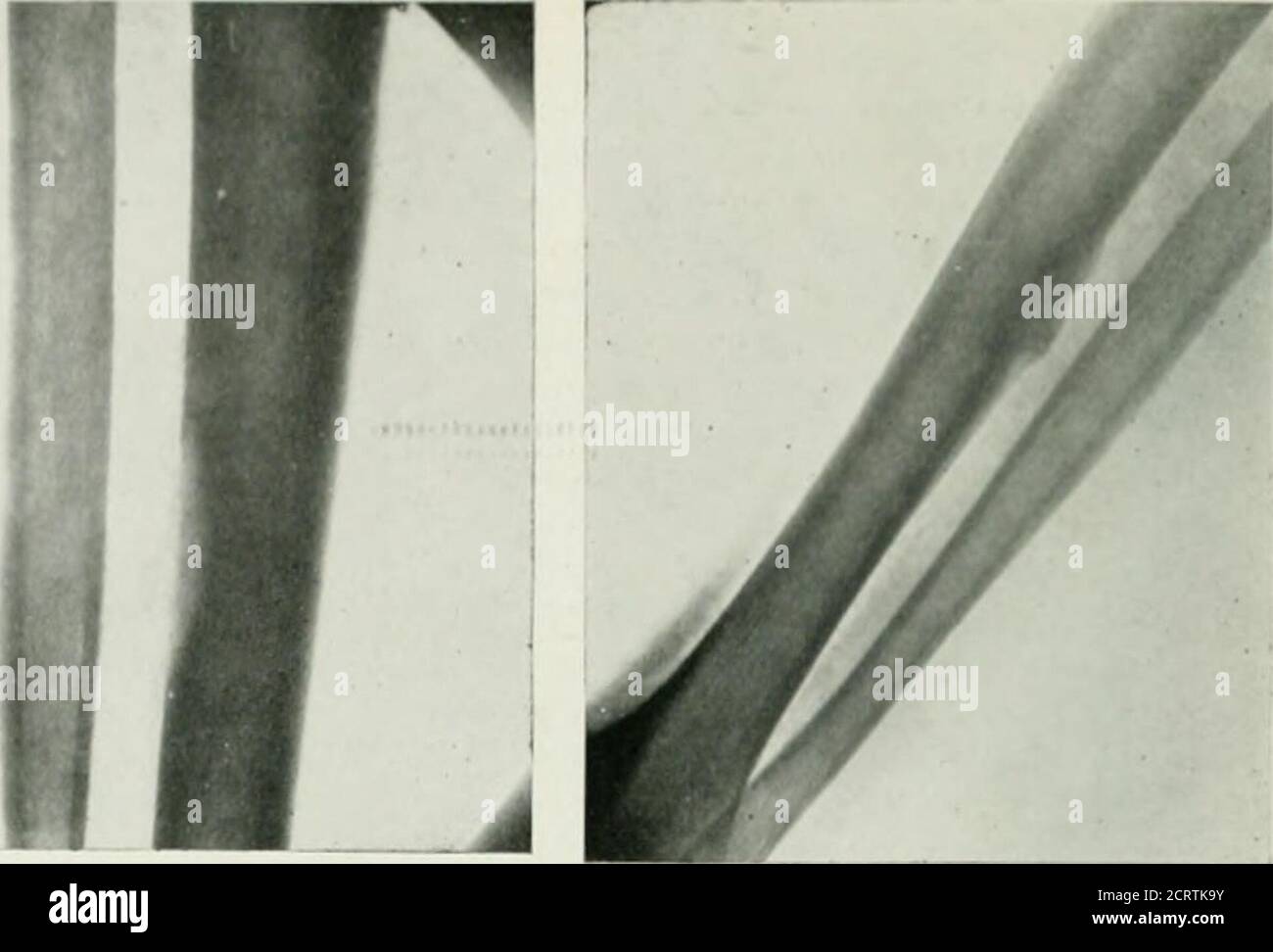 . Archives of physical medicine and rehabilitation . .-a—Case VI ...