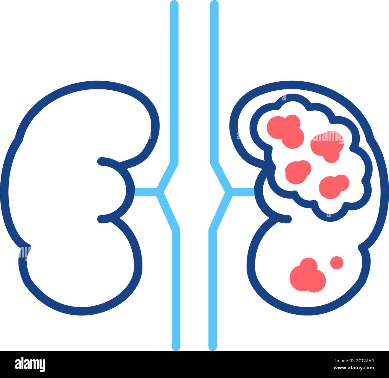 Kidney cancer line color icon. Human organ concept. Malignant neoplasm ...