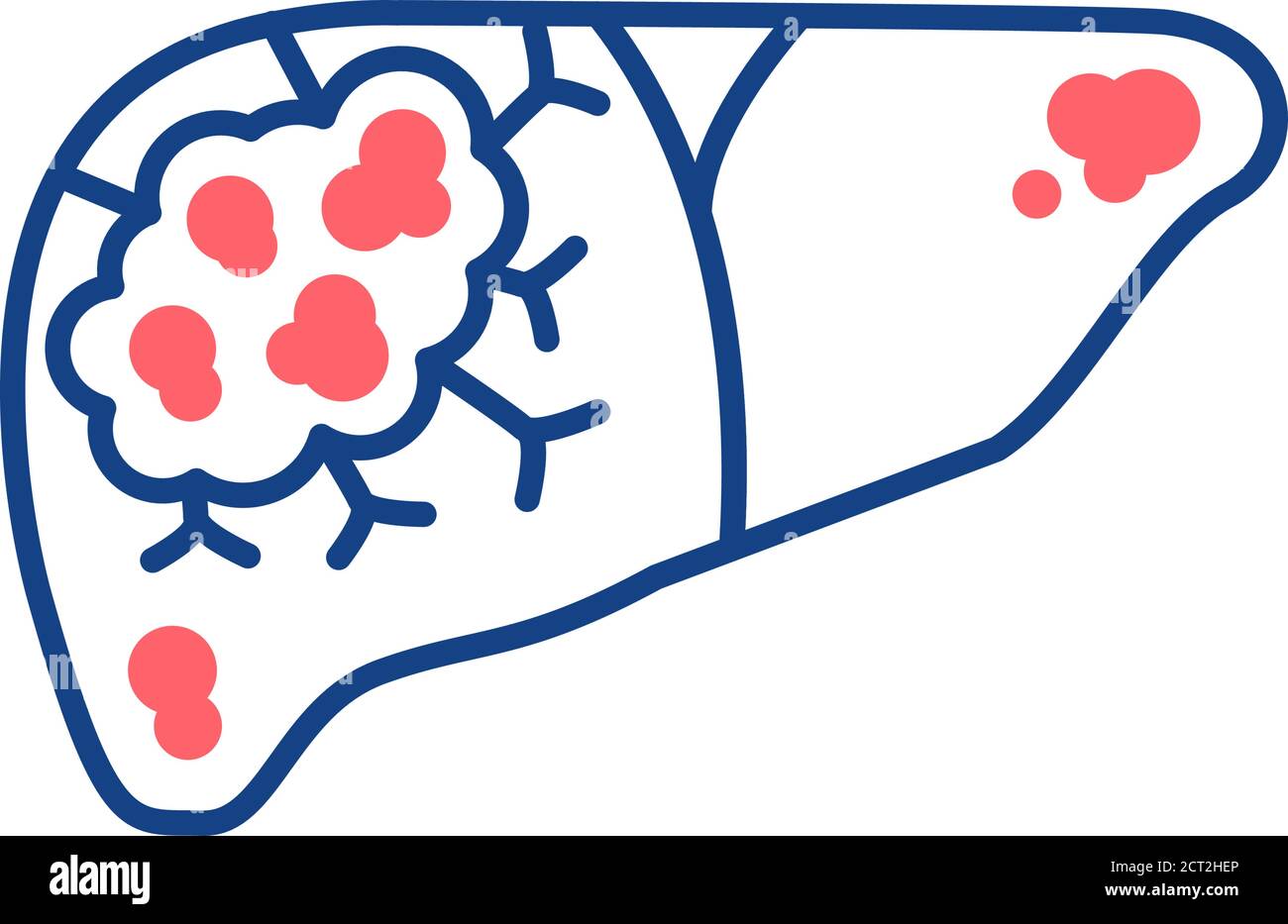 Liver cancer line color icon. Human organ concept. Malignant neoplasm ...