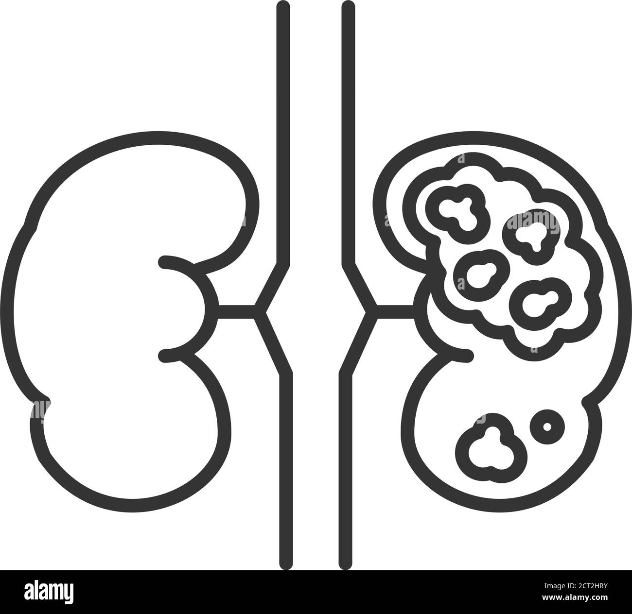 Kidney cancer line black icon. Human organ concept. Malignant neoplasm ...