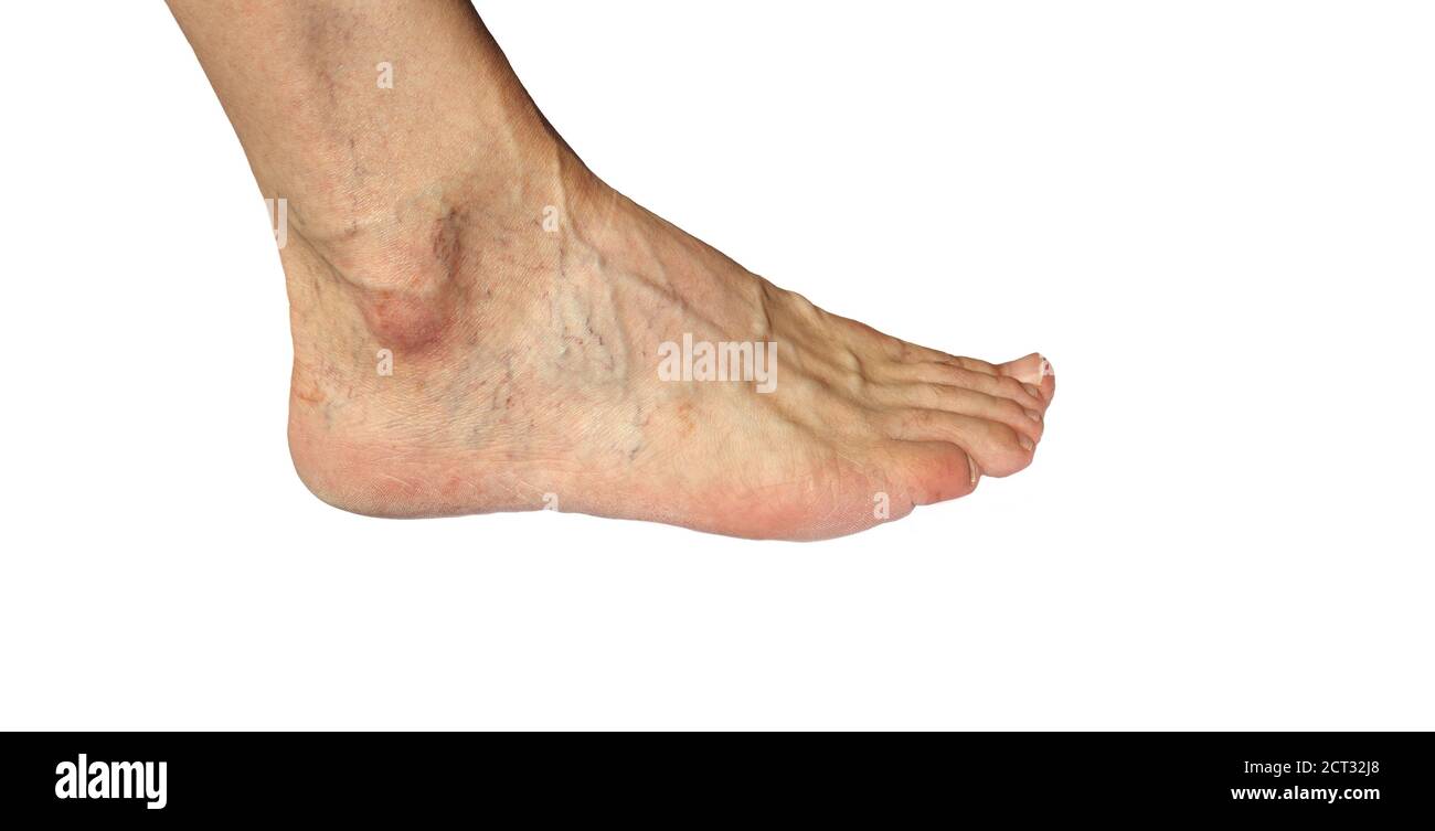 spider veins on and protruding veins male leg on white background Stock ...