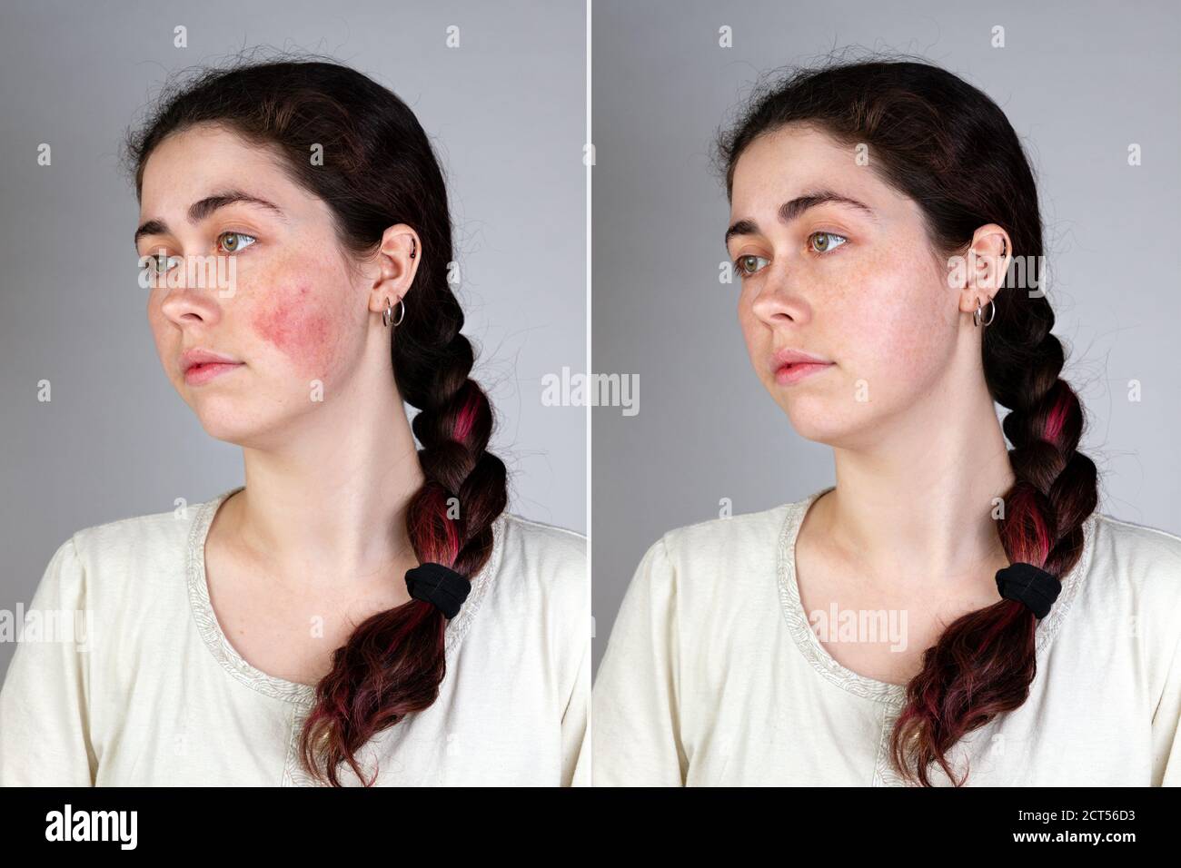 Portrait of a young Caucasian woman showing redness and inflamed blood ...