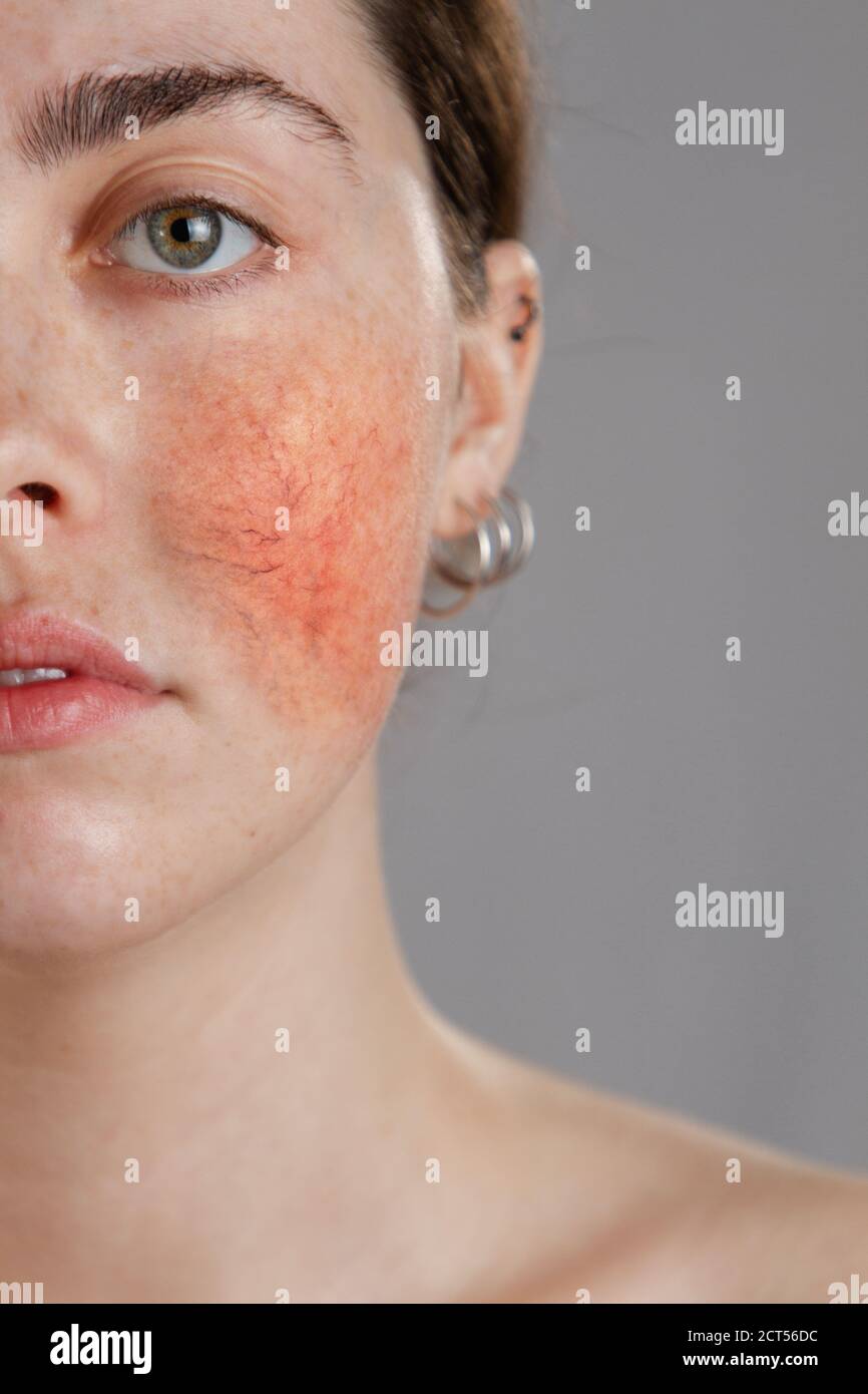Cosmetology and rosacea. Portrait of half the face of a young woman ...
