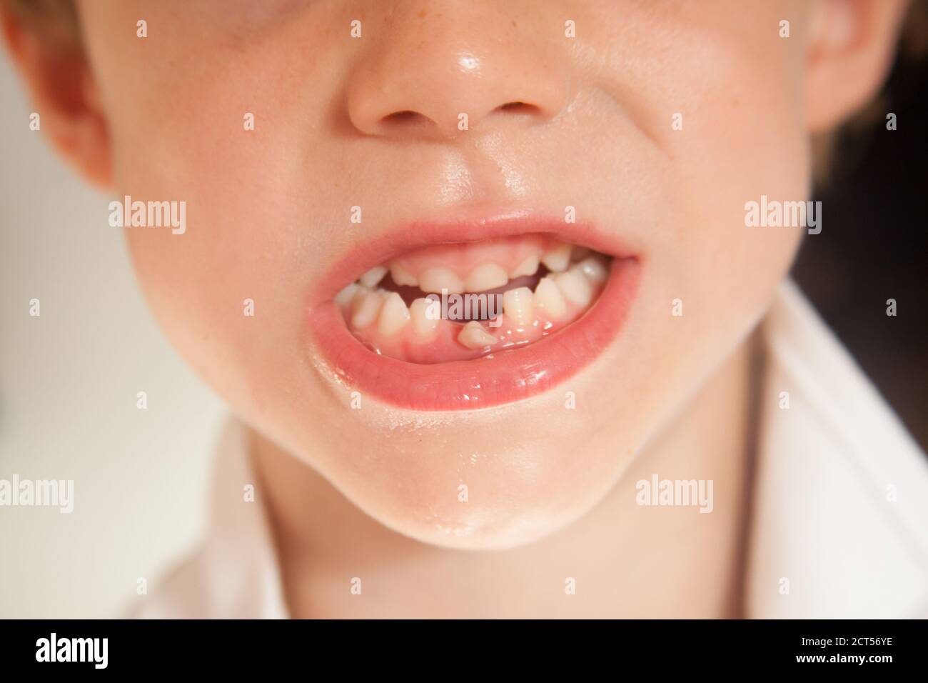 Wobbly Tooth High Resolution Stock Photography and Images - Alamy