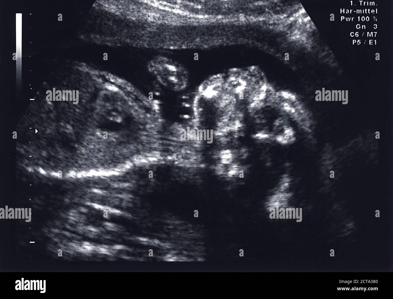 Germany, ultrasonogram of five month old female fetus Stock Photo - Alamy