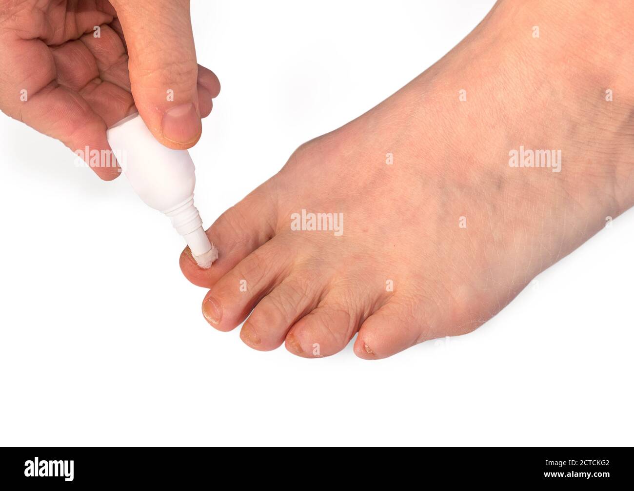 Applying treatment / medicine to toenail fungus infection. Partial foot ...