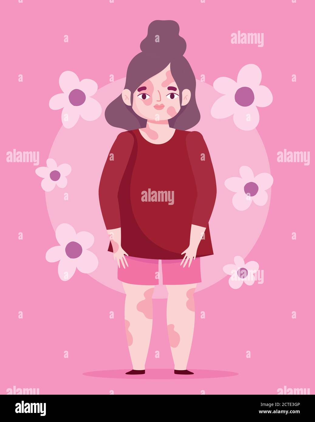 perfectly imperfect, cartoon beautiful woman with problem skin vitiligo ...