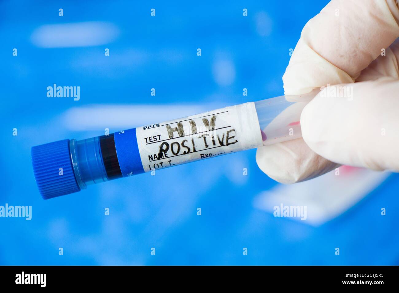 Hiv and aids infection test, hand holding tube with blood on the blue ...