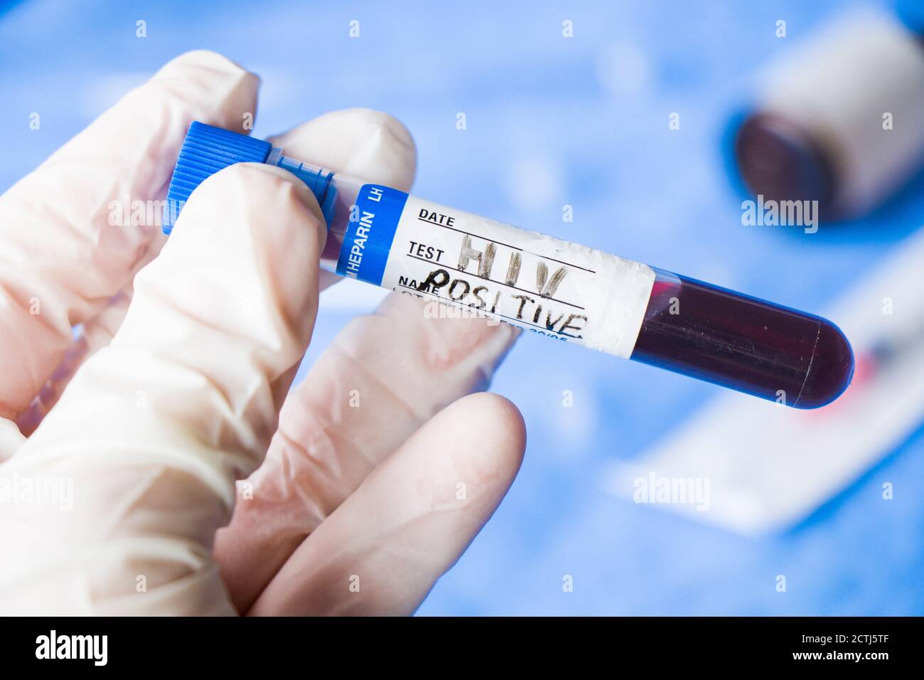 Hiv and aids infection test, hand holding tube with blood on the blue ...
