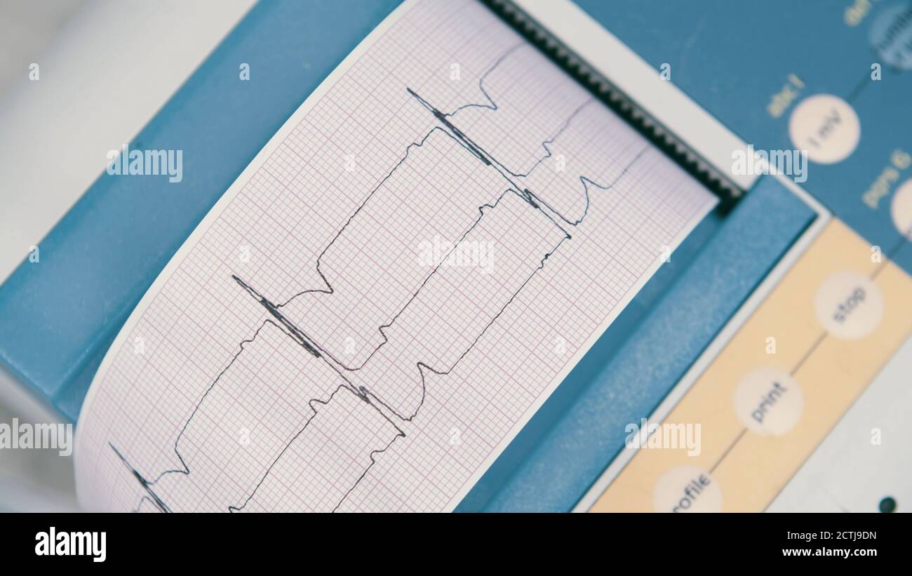 electrocardiograph EKG or ECG diagram printed on grid paper. High ...