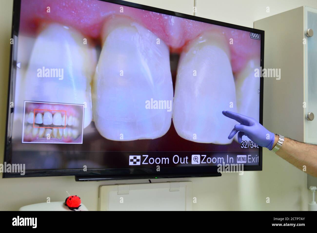 Dentist hand with a glove showing tooth on the screen Stock Photo - Alamy