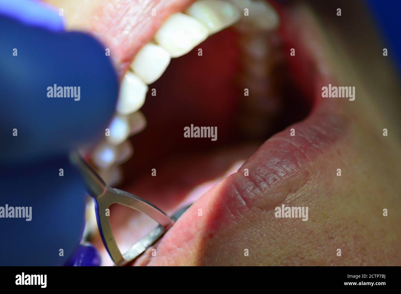 Open mouth during dental examination in a clinic Stock Photo - Alamy