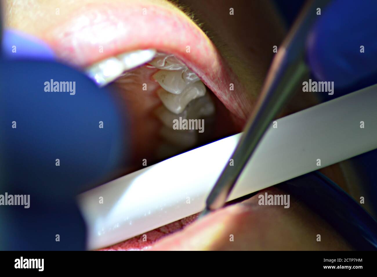 Open mouth during dental examination in a clinic Stock Photo - Alamy