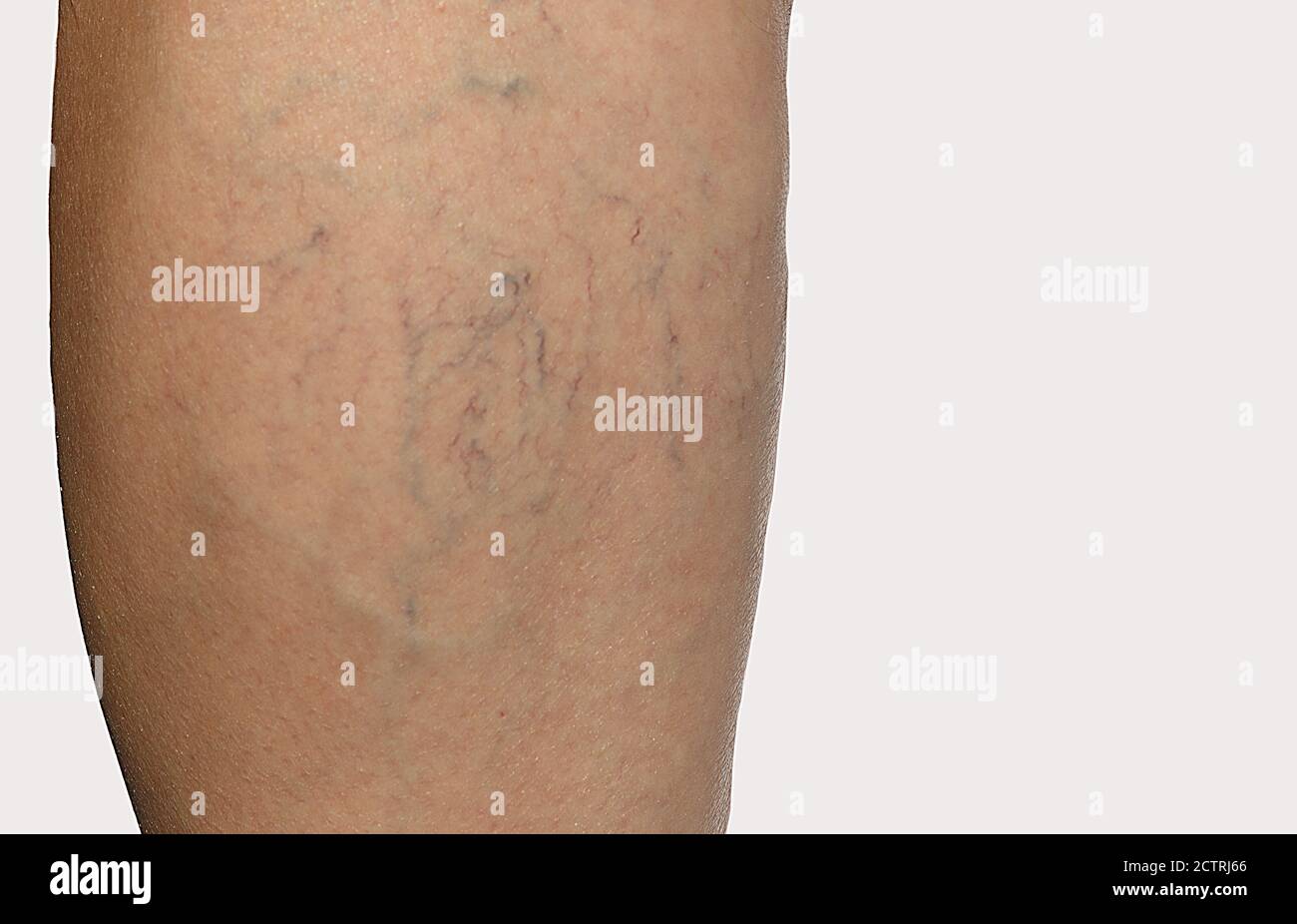 telangiectasia and spider veins on the leg Stock Photo - Alamy