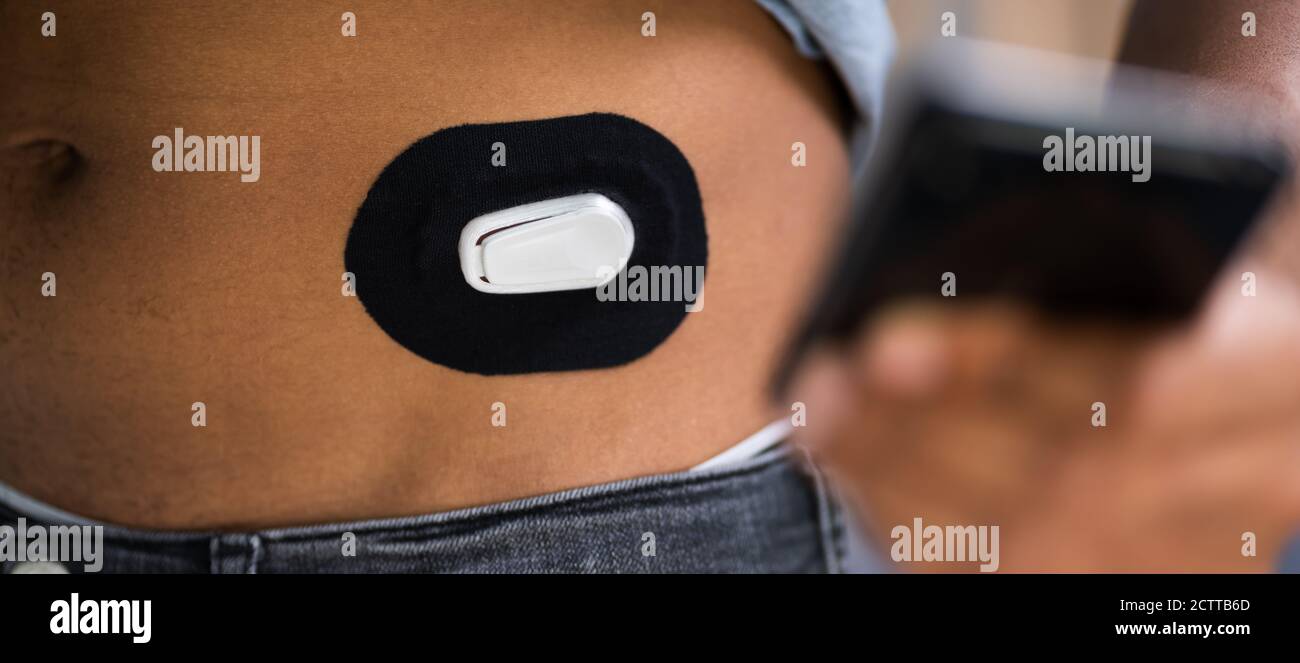 Man Testing Glucose Level With Continuous Glucose Monitor On Mobile ...