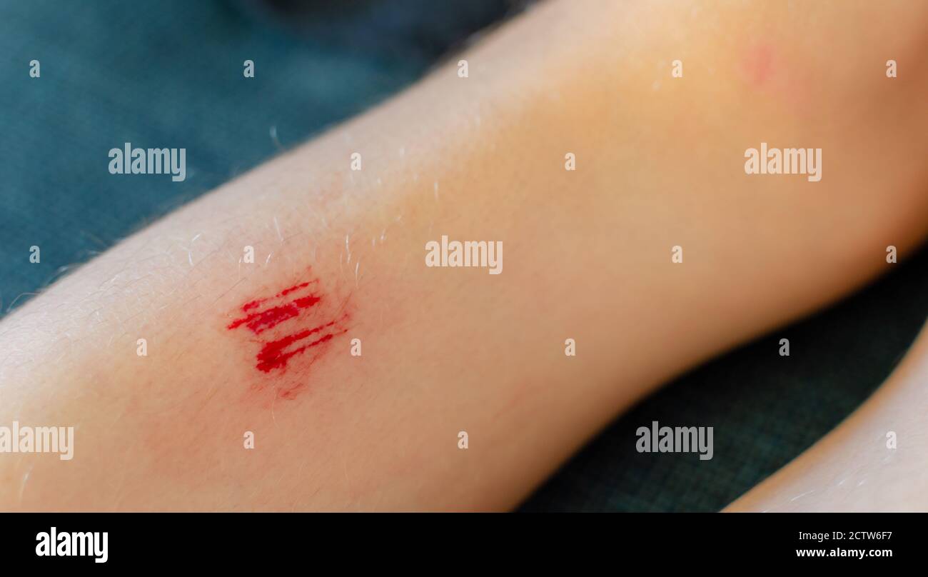 Fresh scratch with blood on a child's leg. Close up Stock Photo - Alamy
