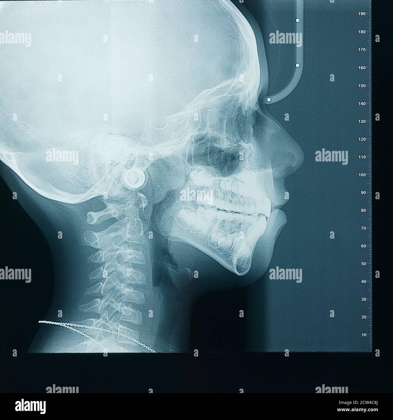 Pediatric brain injury hi-res stock photography and images - Alamy