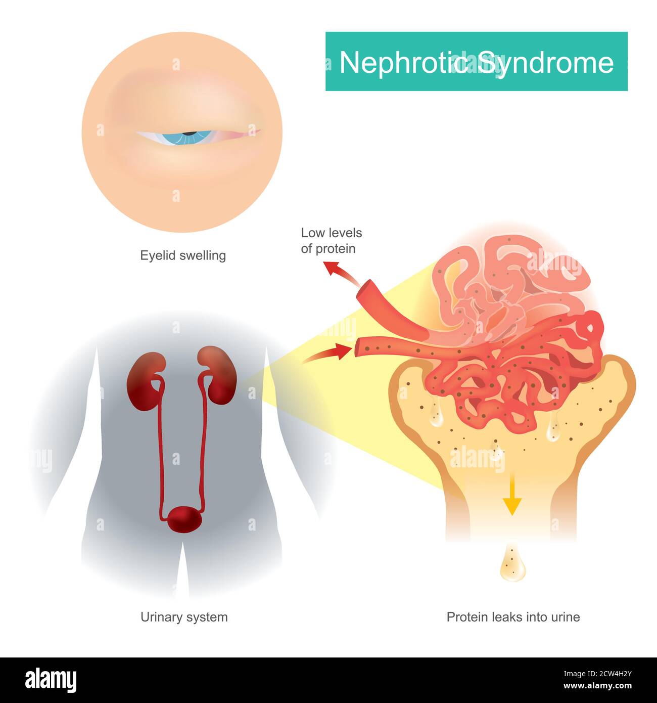 Nephrotic Syndrome. Illustration explain A kidney disorder that causes ...
