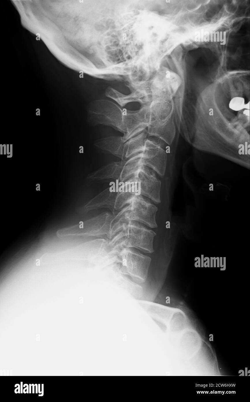 Neck x ray of cervical vertebrae hi-res stock photography and images - Alamy