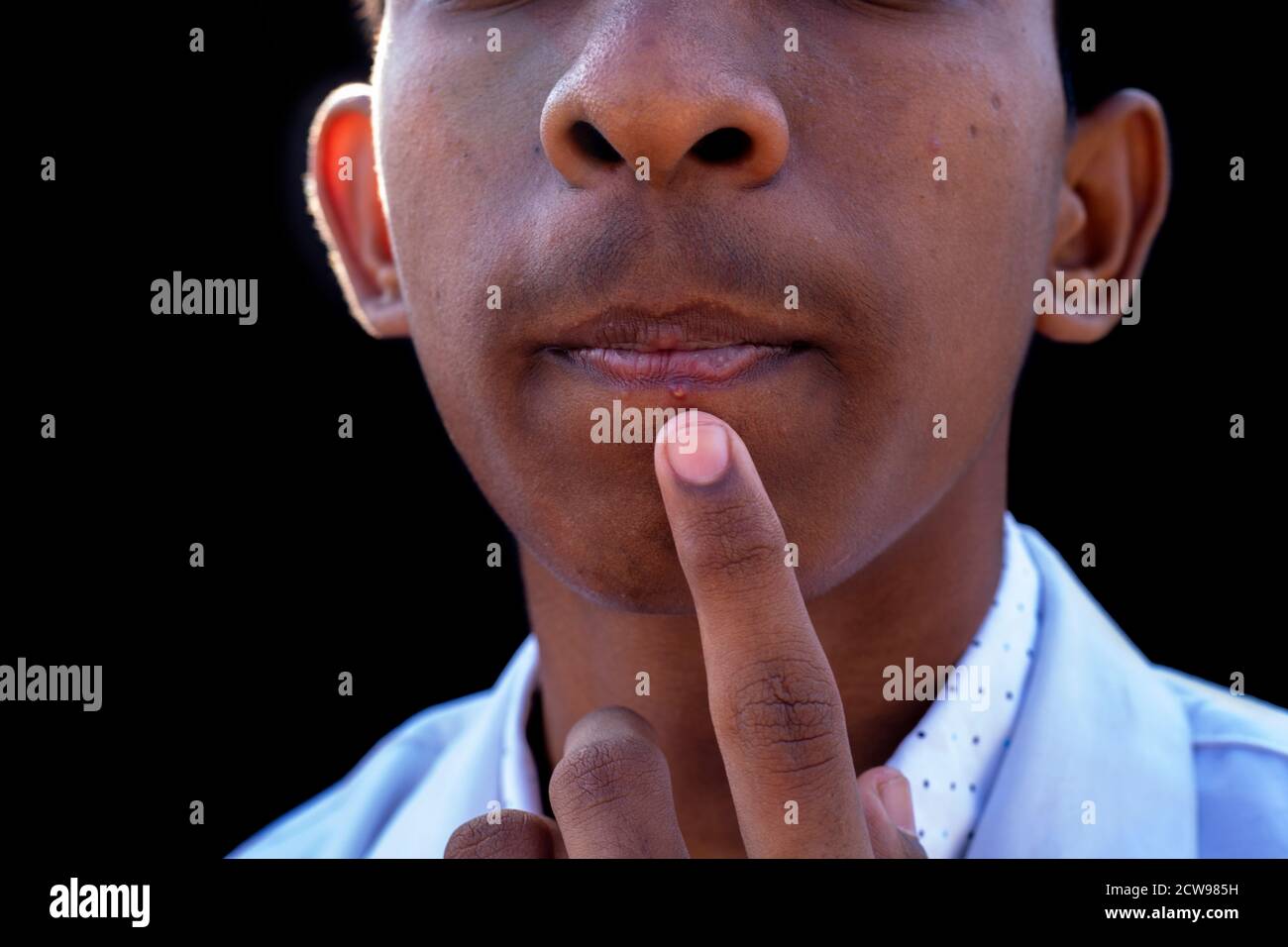 Young man shows fingers on acne on her face Stock Photo - Alamy