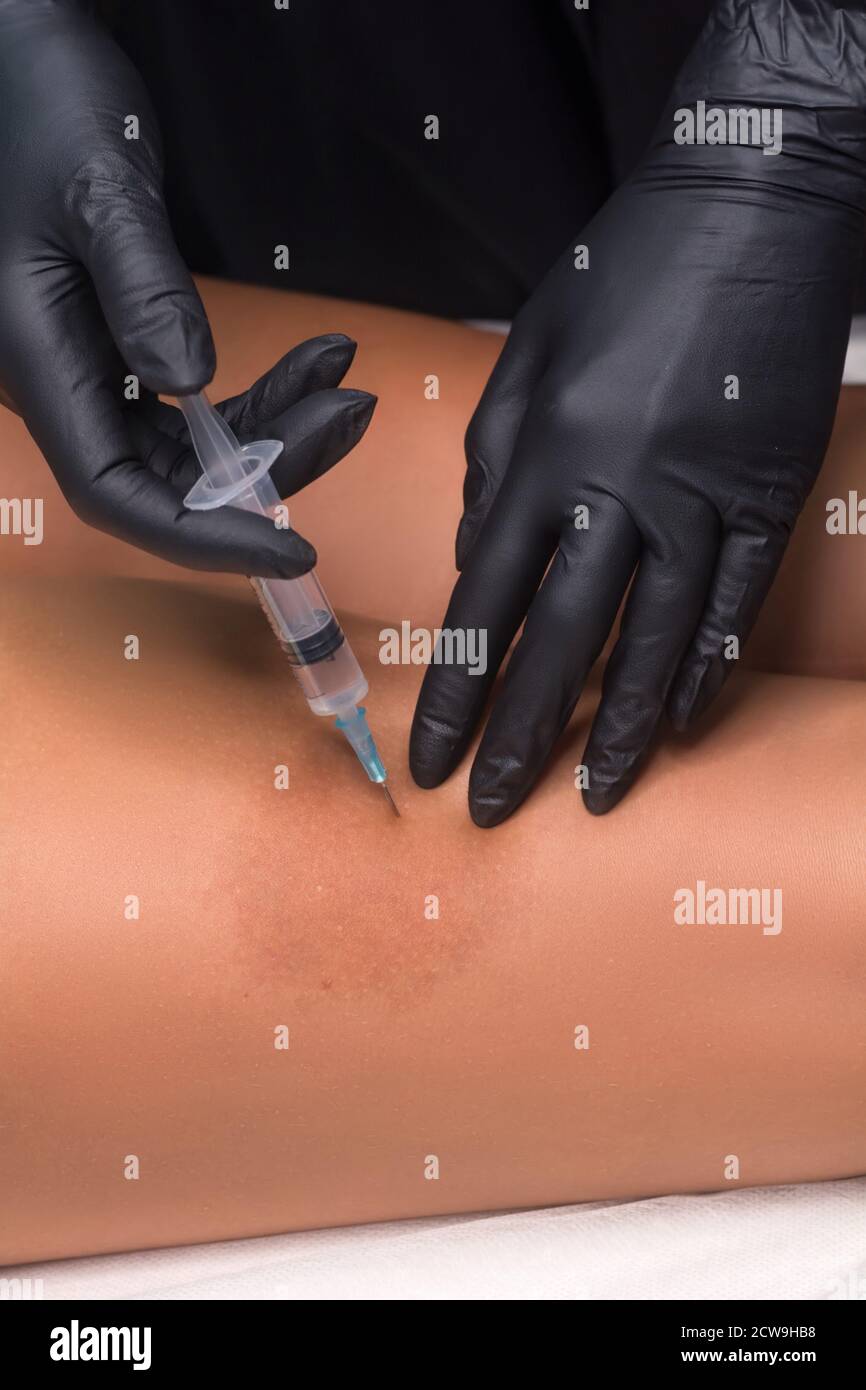 Injection removal of age spots. Salon procedure on the leg of a young ...