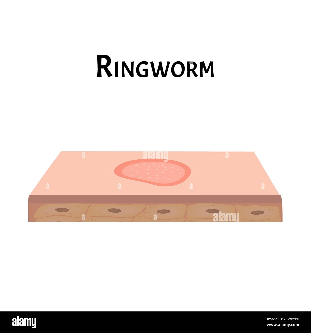 Ringworm on the skin. Vector illustration on isolated background Stock ...