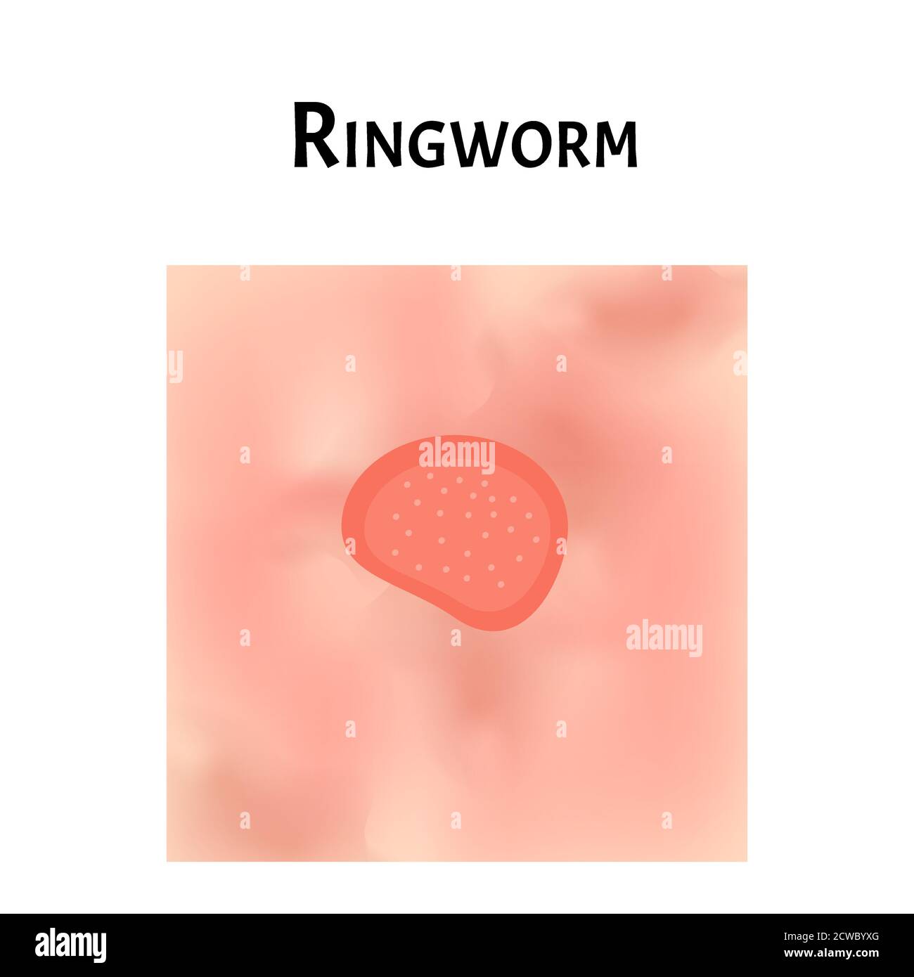 Ringworm of the scalp Cut Out Stock Images & Pictures - Alamy