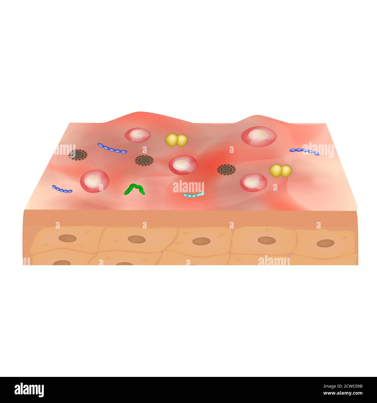 Inflamed skin with bacteria. Infectious diseases of the skin. Vector ...