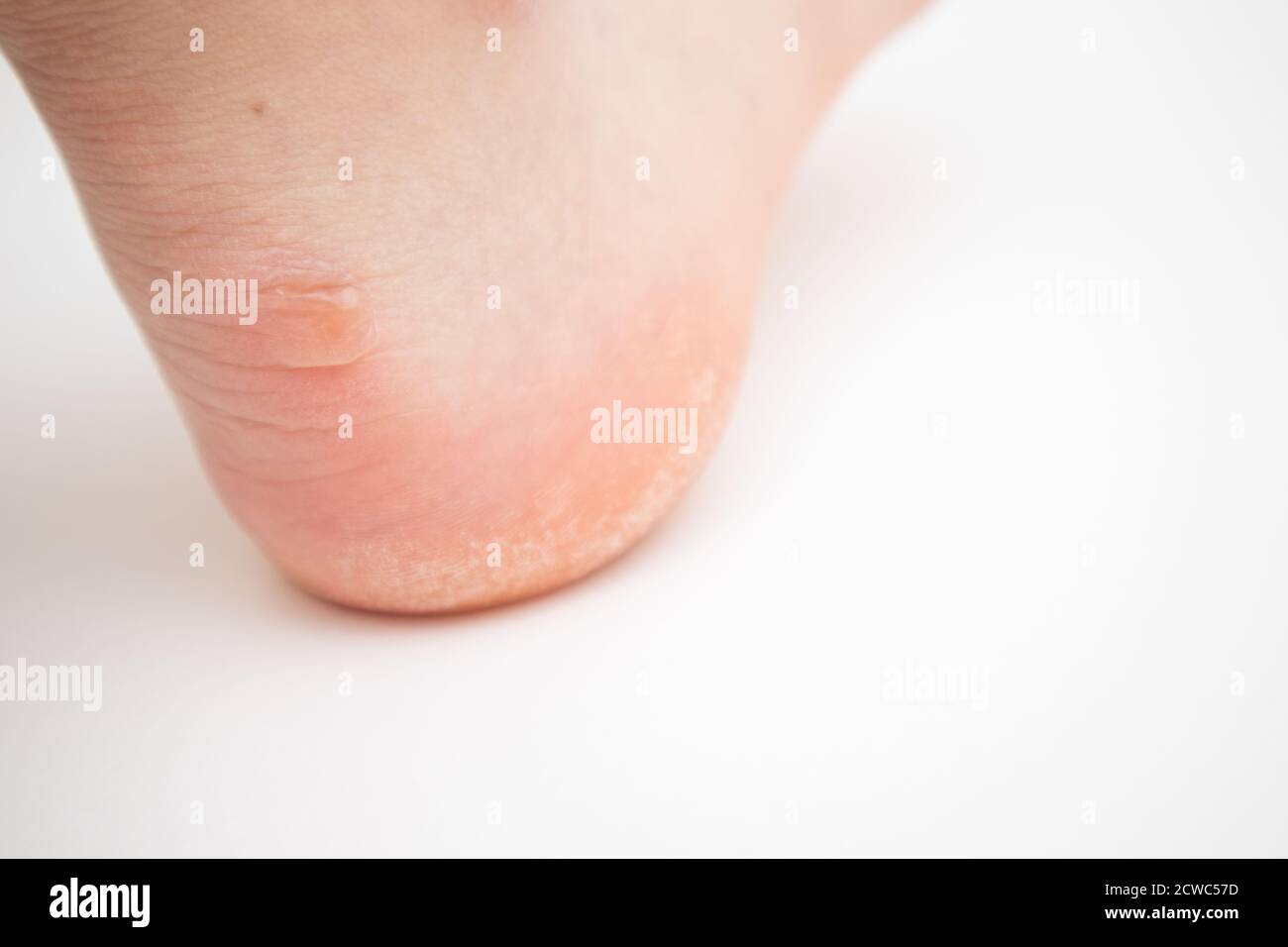 Big callus on heel. Feet with callus of dead skin Stock Photo - Alamy