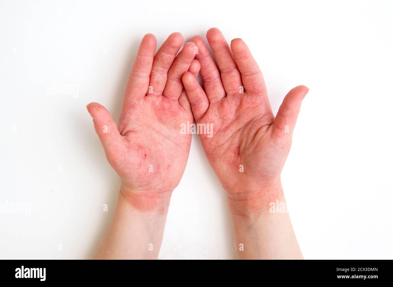 Swollen hand hi-res stock photography and images - Alamy