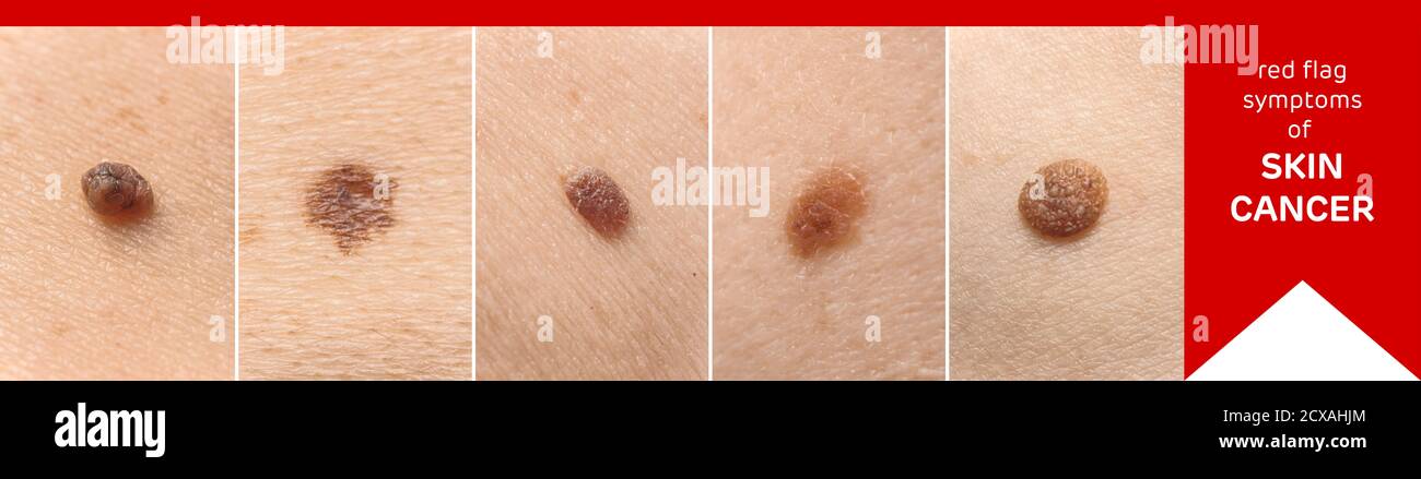 Different types of moles on human skin, closeup. Concept of skin cancer ...