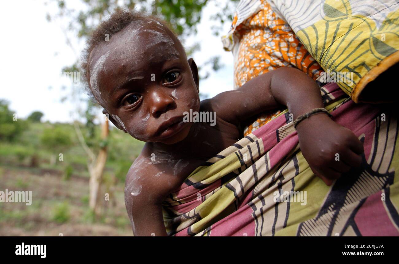 African chicken pox hi-res stock photography and images - Alamy