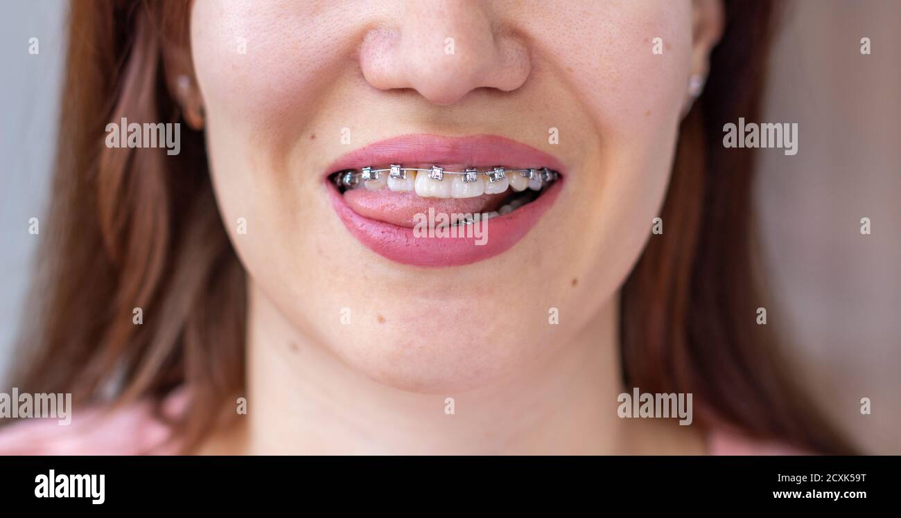 brasket system in smiling mouth, macro photo teeth, close-up lips Stock ...