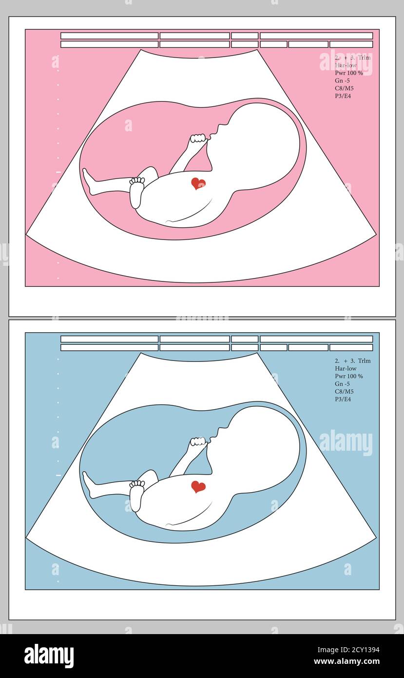 Ultrasound of unborn baby in mother's womb, boy or girl, medical ...