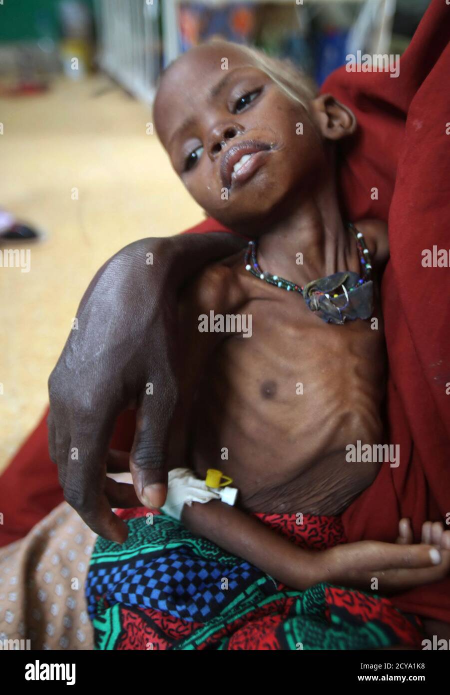 Anorexic Kids In Africa