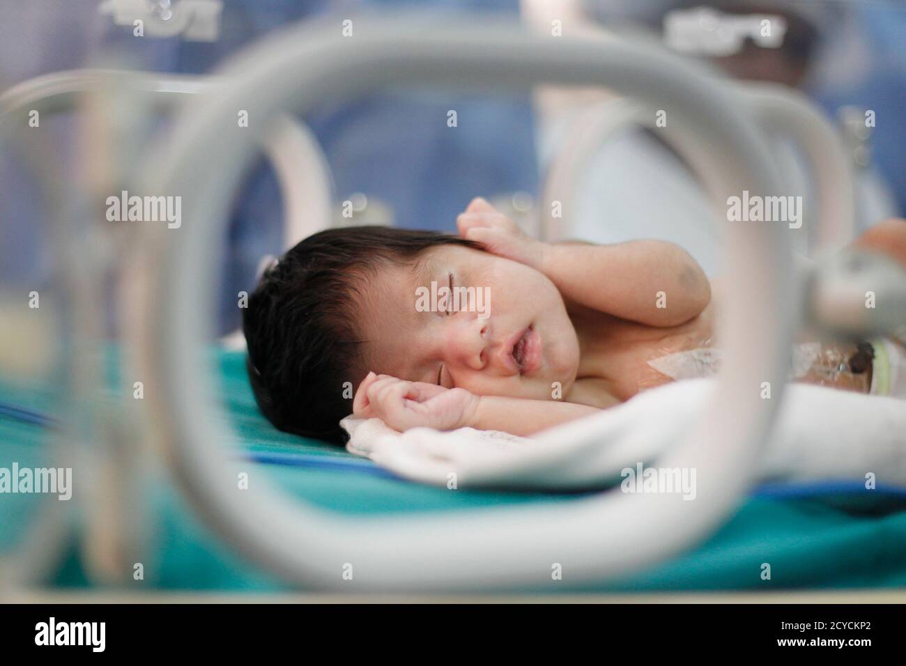 Conjoined twins born hi-res stock photography and images - Alamy